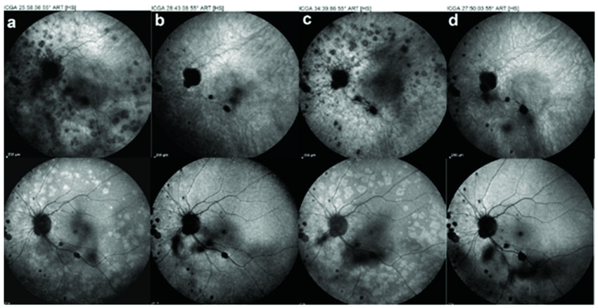 What Is Idiopathic Multifocal Choroiditis and How to Manage It|OBN