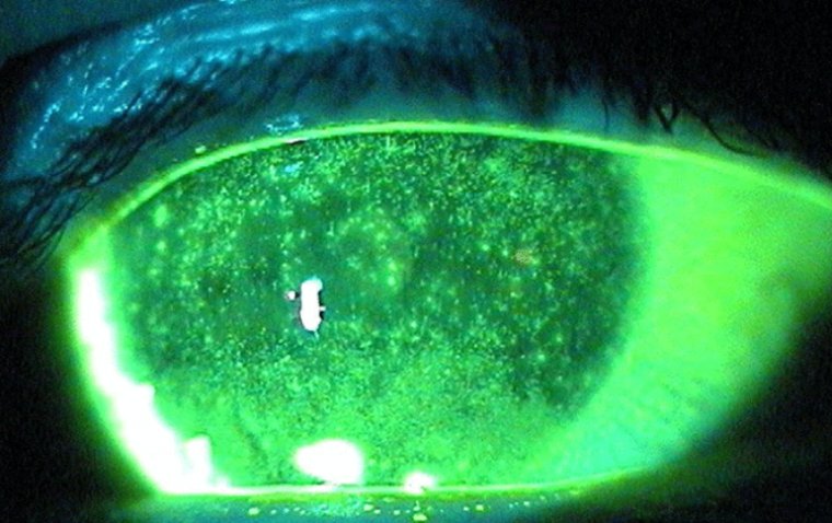 Corneal Staining: Causes, Symptoms and Management | OBN