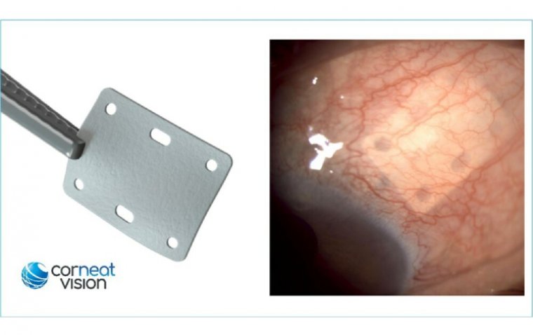 Alcon Launches Voyager DSLT for Glaucoma Treatment | OBN