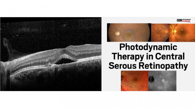 Central Serous Retinopathy Symptoms