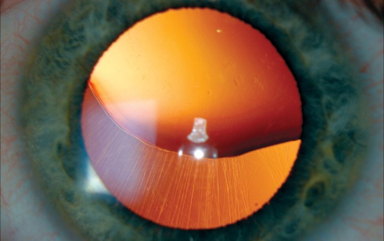 Guide to Intracapsular Cataract Extraction (ICCE) | OBN